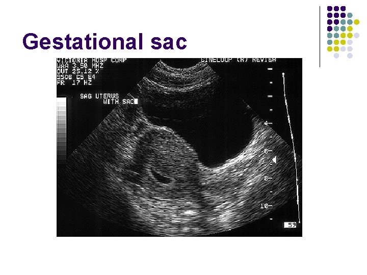 Early Pregnancy Problems Introduction Bleeding in early pregnancy