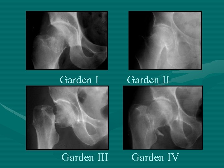 Fracturile membrului inferior Prof Dr M Popescu Fractura