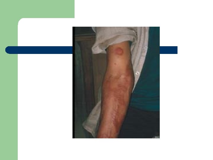 Hansens Disease The Other Mycobacterium Diane Rimple MD