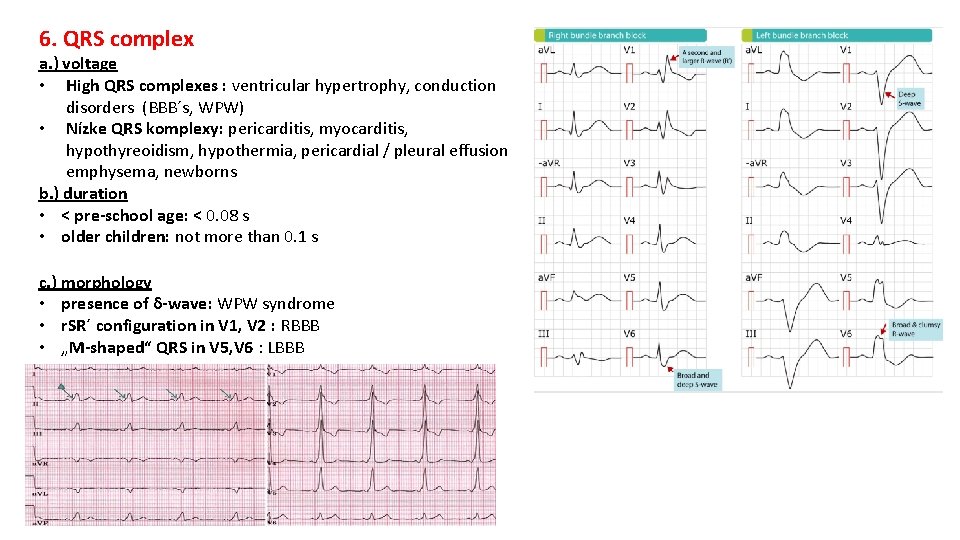 ECG changes in children Pediatric Cardiac Centre Bratislava