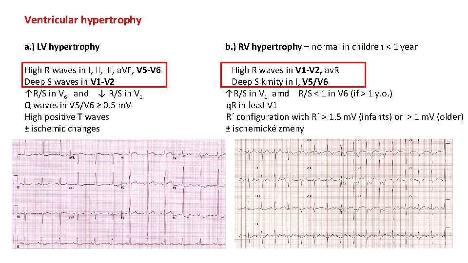 ECG changes in children Pediatric Cardiac Centre Bratislava