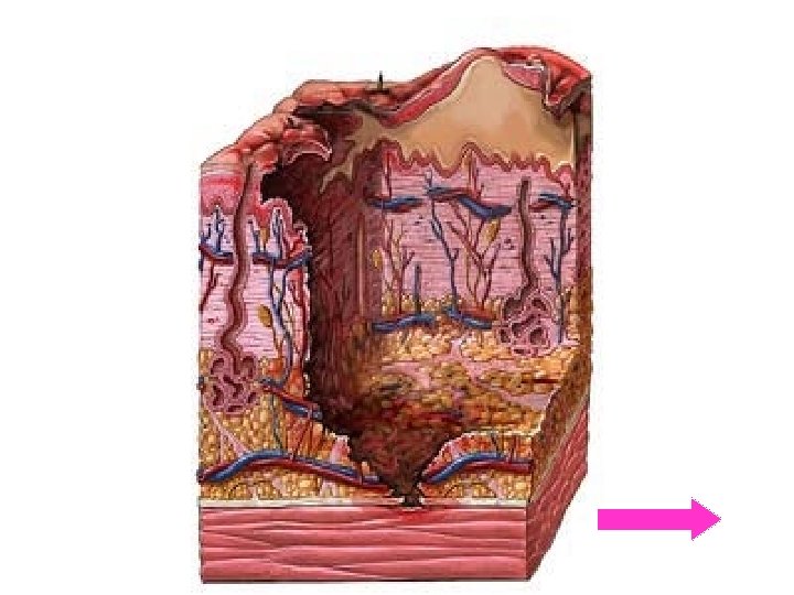 Definition Destruction of tissues caused by physical heat