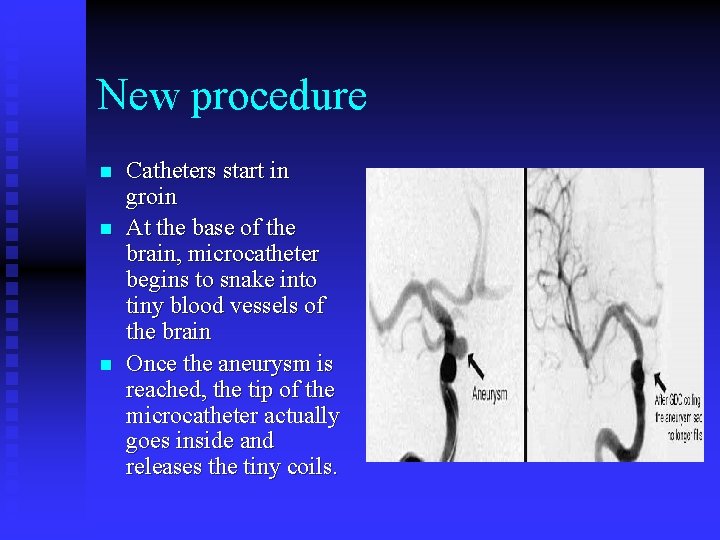 Improving Microcatheter Navigation Through the Brain Matt Kergosien