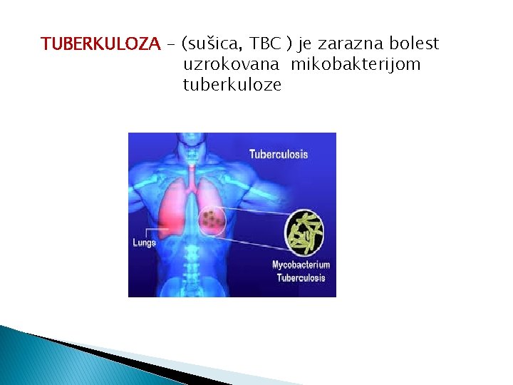 SESTRINSKA SKRB BOLESNIKA S TUBERKULOZOM Milica Kljak Sanda