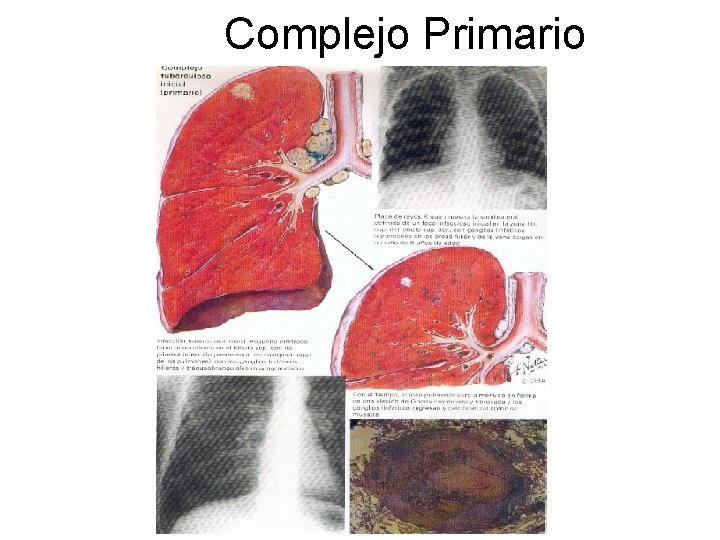 Programa de Control de la Tuberculosis Dr Flix