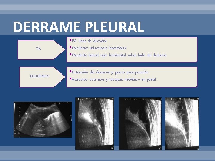 DERRAME PLEURAL RX ECOGRAFA PA lnea de derrame