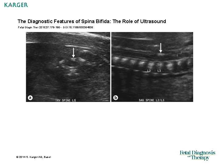 The Diagnostic Features of Spina Bifida The Role