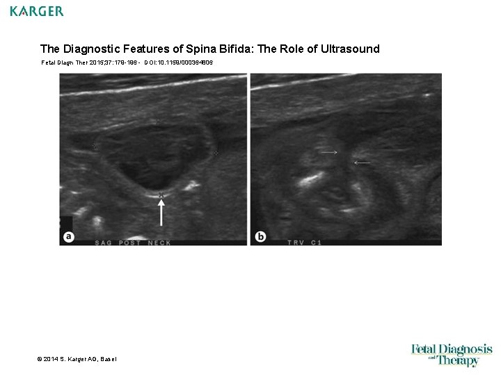 The Diagnostic Features of Spina Bifida The Role
