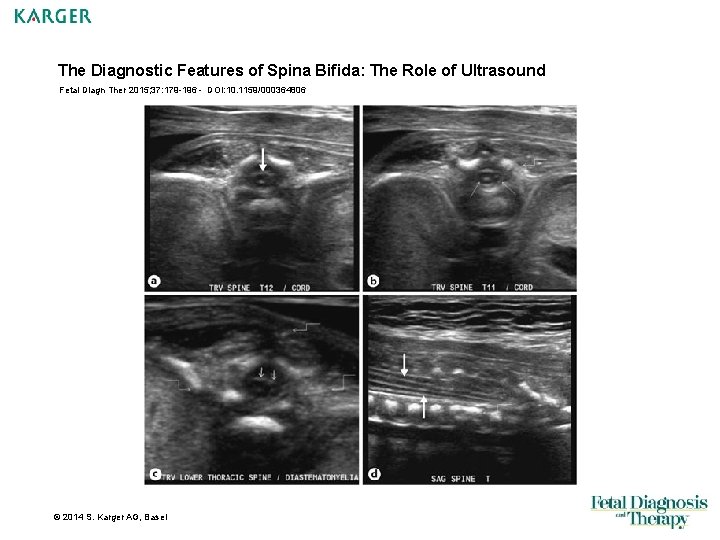 The Diagnostic Features of Spina Bifida The Role