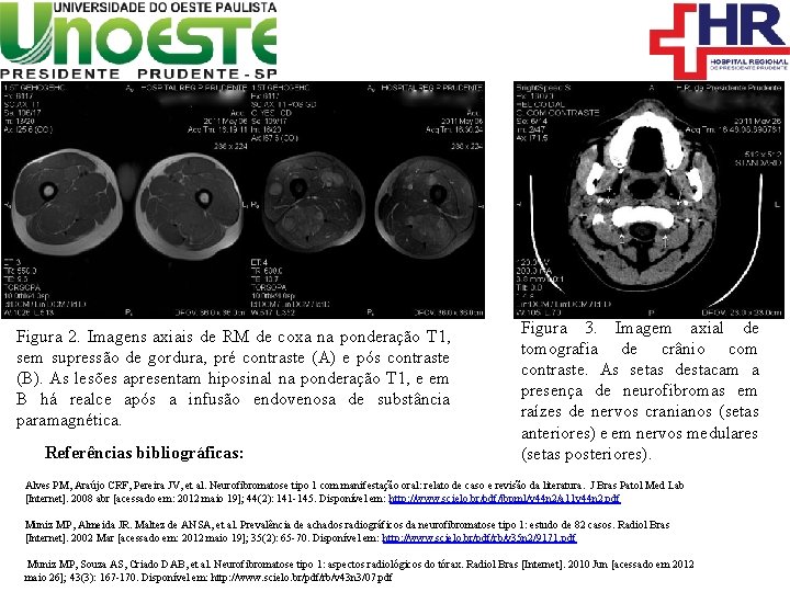 NEUROFIBROMATOSE TIPO 1 DISCREP NCIA CLNICA IMAGENOLGICA Neurofibromatosis