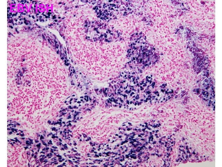 33M Cervical lymphadenopathy RO TB RO nonspecific lymphadenopathy