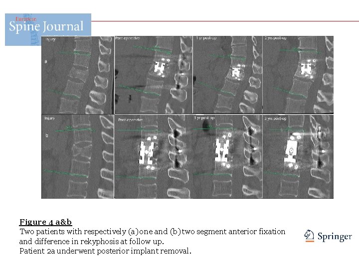 Key points Thoracoscopy anterior stabilization titanium cage thoracic