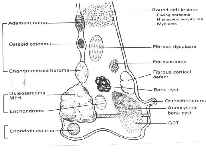 BONE TUMORS BY ALI IBRAHIM MD Bone tumors