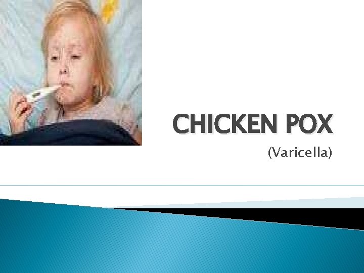 CHICKEN POX Varicella INTRODUCTION It is a common
