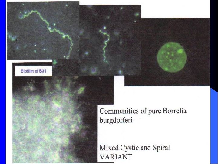 Biofilms Methylation Heavy Metal Detoxification in Lyme Disease