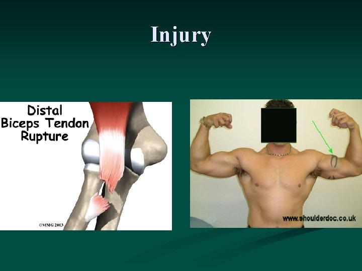 Distal Biceps Rupture Thomas J Kovack DO Distal