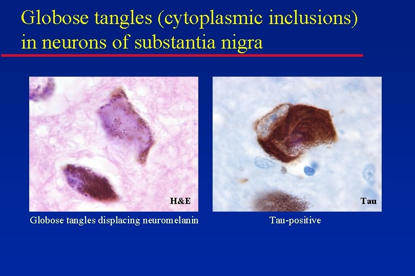 CPC 7 Pathology Barbara J Crain MD Ph