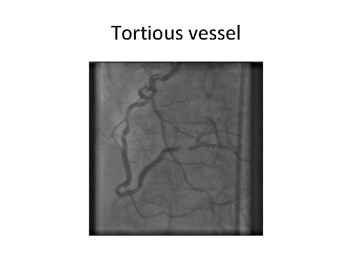 Advances in coronary artery bypass surgery History First