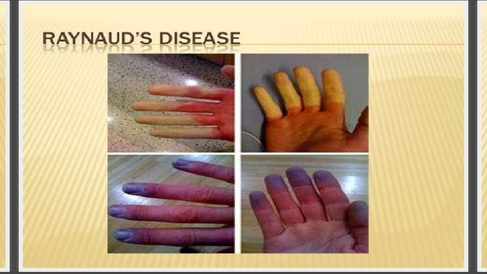 DEFINITION Raynauds disease is a condition which causes