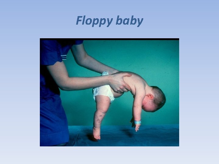 CEREBRAL PALSY Definition Epidemiology A group of non