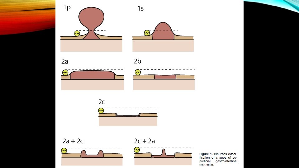 ENDOSCOPIC FEATURES OF COLORECTAL POLYPS Colorectal cancer is
