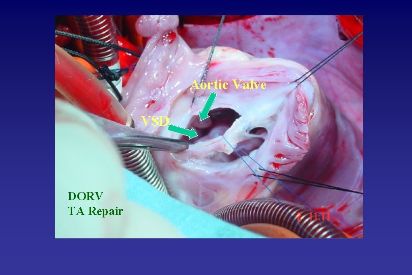 DORV MANAGEMENT History 1957 Kirklin at Mayoclinic by