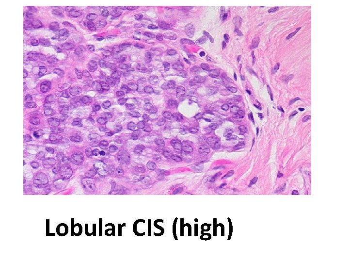 Breast Pathology Breast pathology Inflammatory Disorders Acute Mastitis