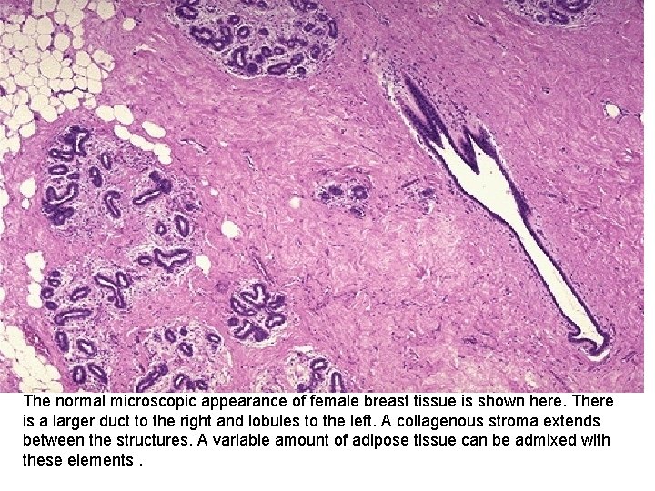 Breast Pathology Breast pathology Inflammatory Disorders Acute Mastitis