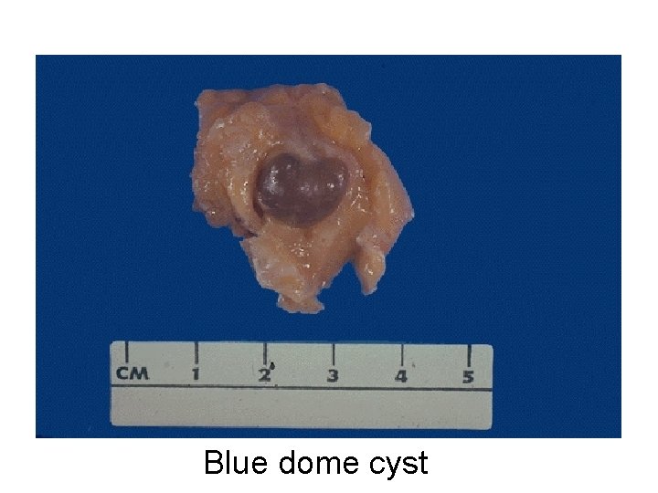 Breast Pathology Breast pathology Inflammatory Disorders Acute Mastitis
