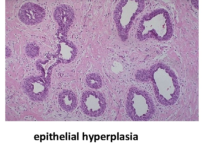 Breast Pathology Breast pathology Inflammatory Disorders Acute Mastitis