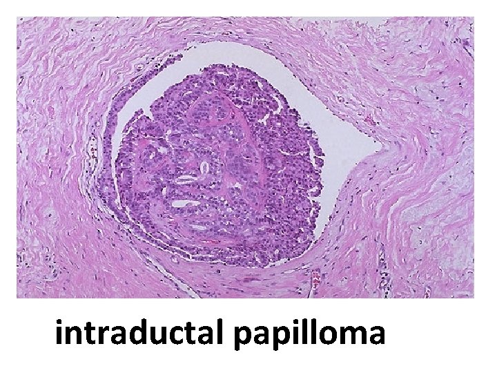 Breast Pathology Breast pathology Inflammatory Disorders Acute Mastitis