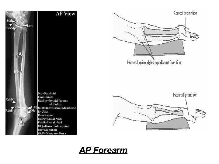 Lecture 8 Forearm Basic Projections Anteroposterior AP Lateral