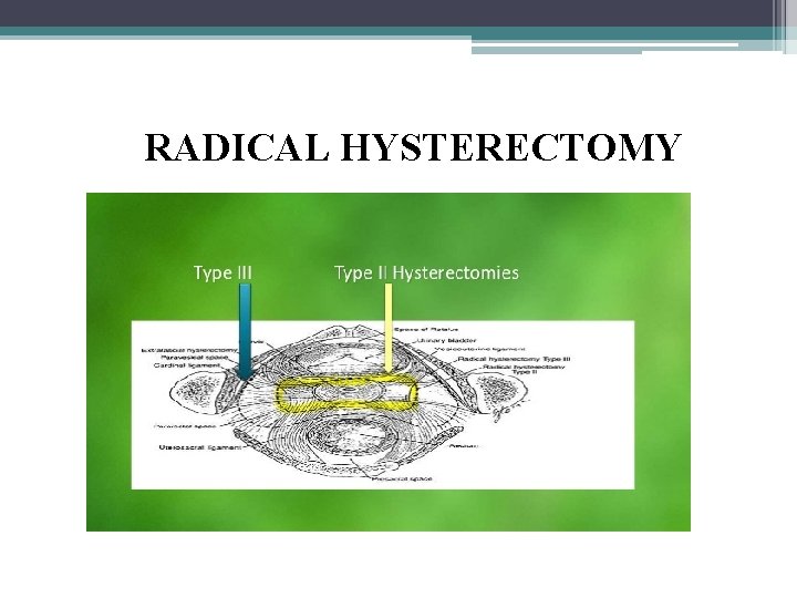 LAPAROSCOPIC RADICAL HYSTERECTOMY AND BILATERAL PELVIC LYMPHADENECTOMY OUR