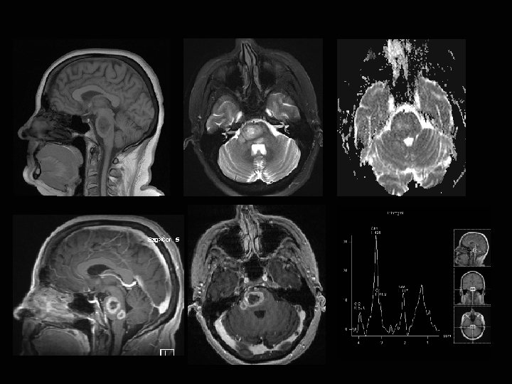 UNC Neuroradiology Neuropathology Conference November 2012 Stephen Bagg