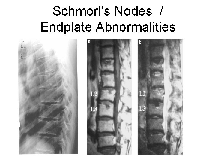 Dr Pete Rose Spine Abnormalities Photos Scoliosis Abnormal