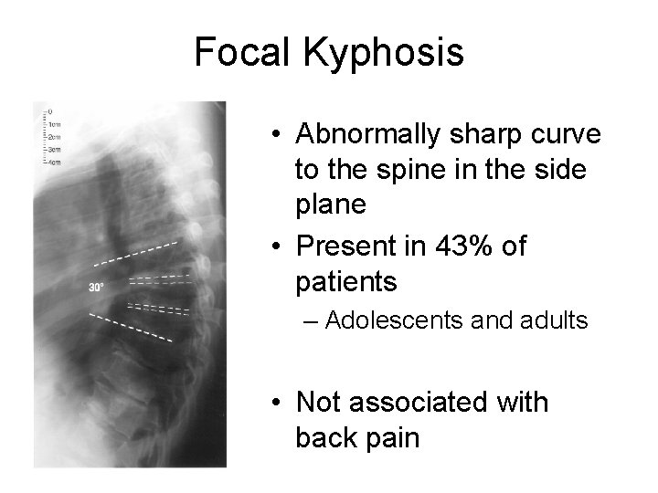 Dr Pete Rose Spine Abnormalities Photos Scoliosis Abnormal