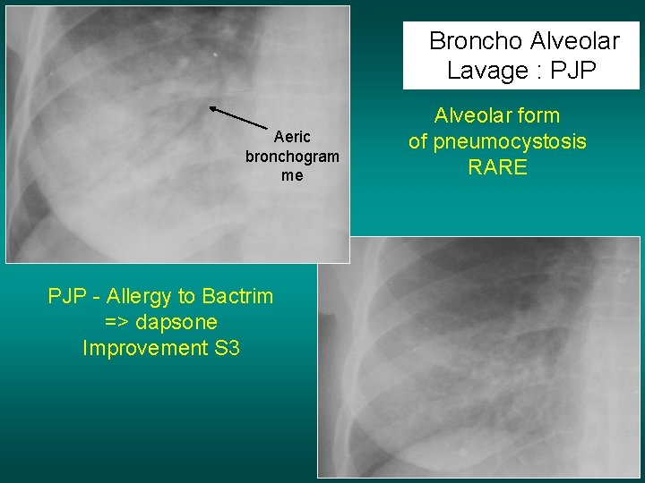 Radiological syndroms Alveolar syndrome Bronchial syndrome Interstitial ...