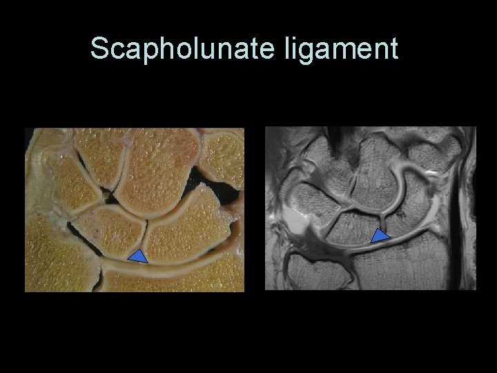 Carpal Instability Weiling Chang Carpal Instability Definition Inability