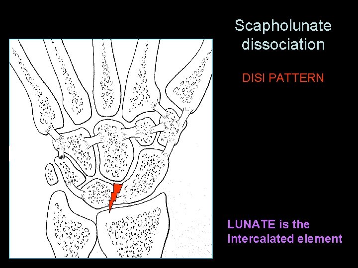 Carpal Instability Weiling Chang Carpal Instability Definition Inability