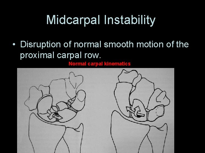 Carpal Instability Weiling Chang Carpal Instability Definition Inability