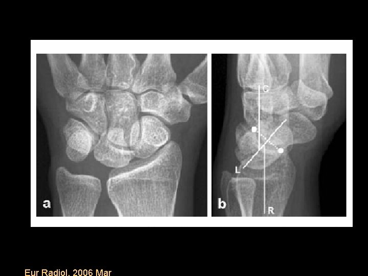 Carpal Instability Weiling Chang Carpal Instability Definition Inability