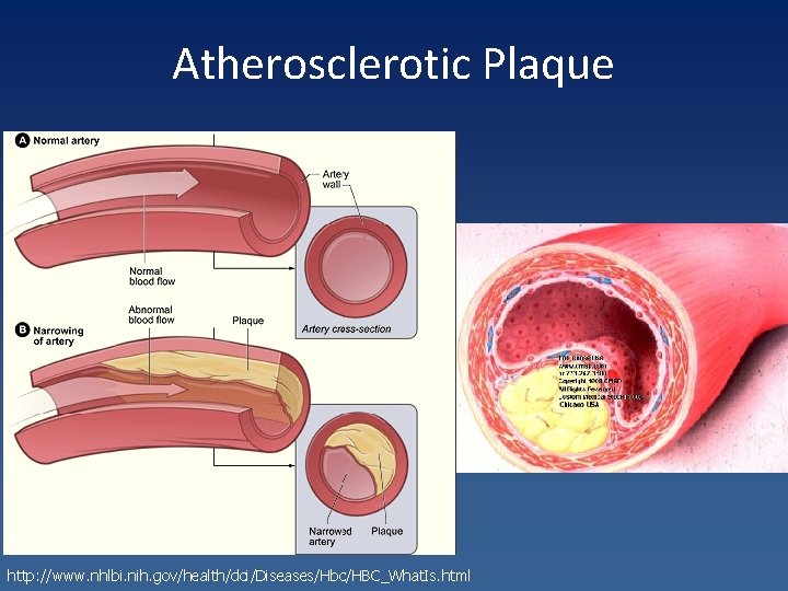 Lecture 18 Cardiovascular Disease Stroke and Heart Attack