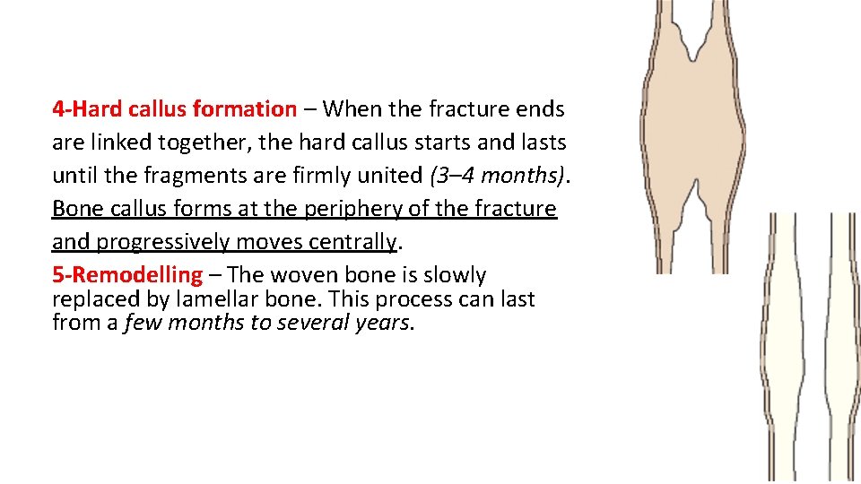 HOW FRACTURES HEAL Done by Alaa khreisat Fracture