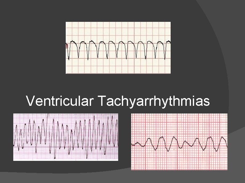 Arrhythmias By Sasha Darwazeh FY 1 Types of