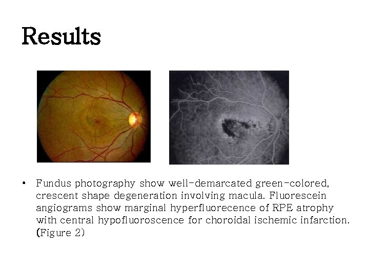 Phototoxic Maculopathy After Scleral Sutured IOL Implantation NC
