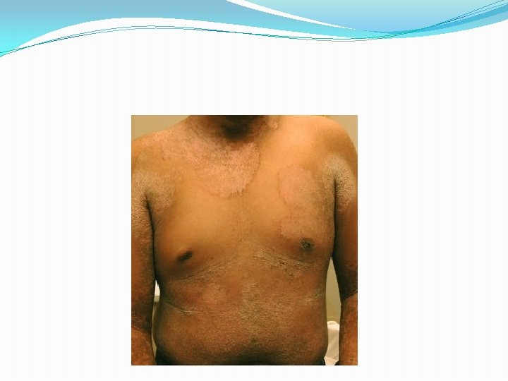 Ichthyosis Dr Awad AlTarawneh MD Consultant Dermatologist and