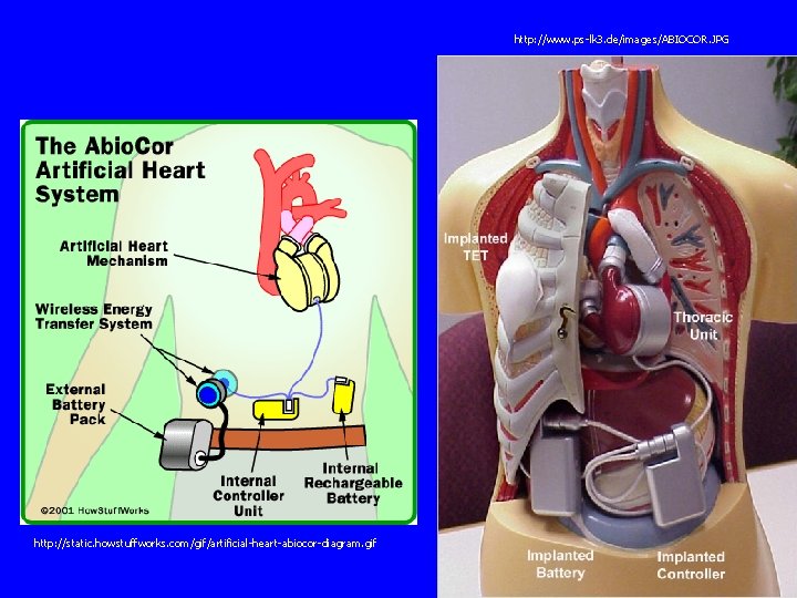 BME 301 Lecture Nineteen Progression of Heart Disease