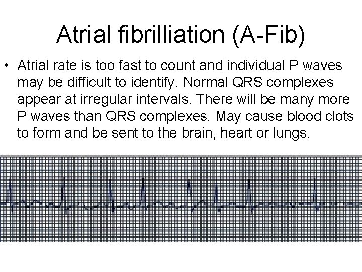 ECG NOTES Conduction System Heart Beat Graphic from