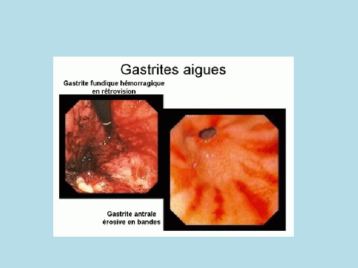 Gastrites Aigues ou chroniques Quest ce quune gastrite