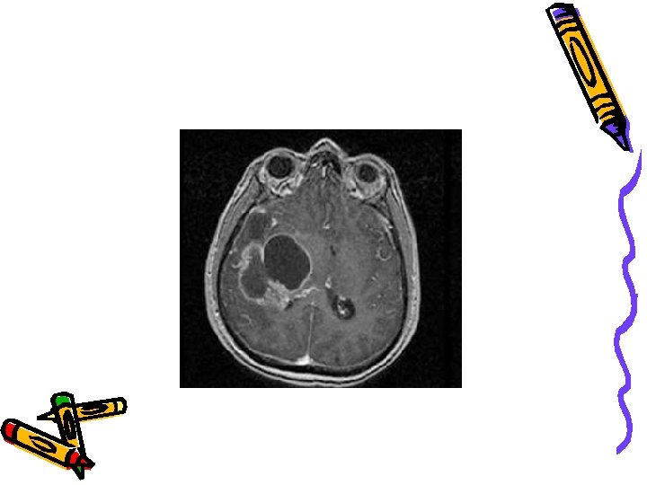 Brain Tumors Ainshams University Neurosurgery department Classification ...